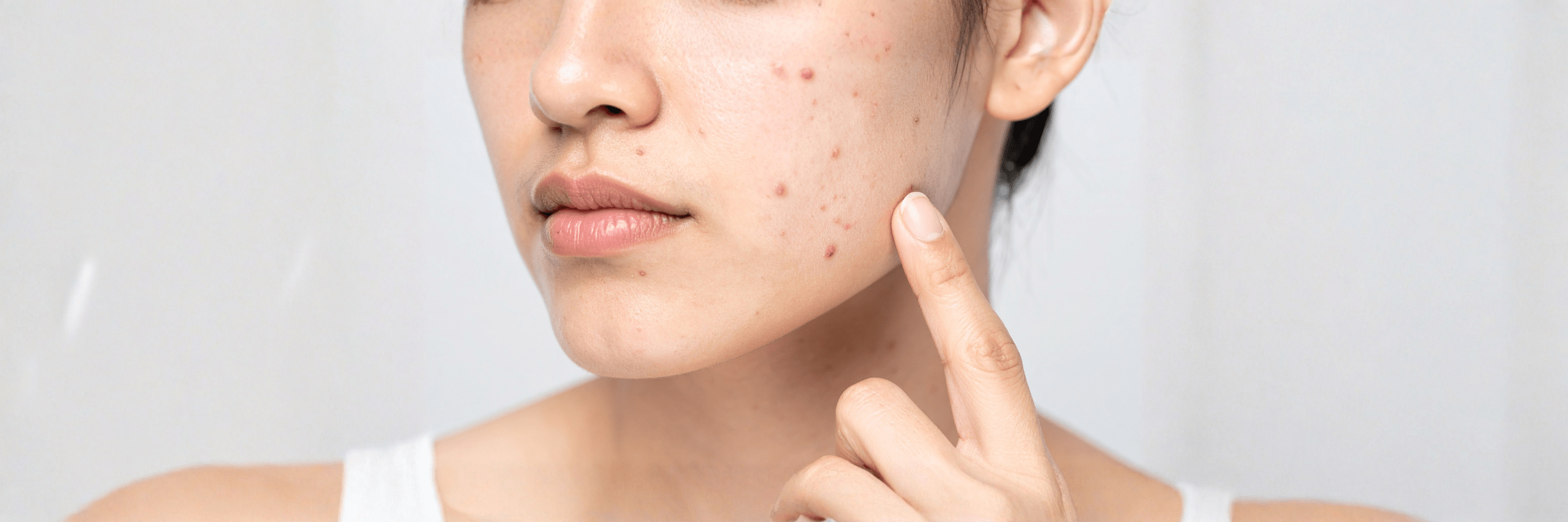 How to Get Rid of Pimples Naturally: A Complete Guide for – Cosmosentials